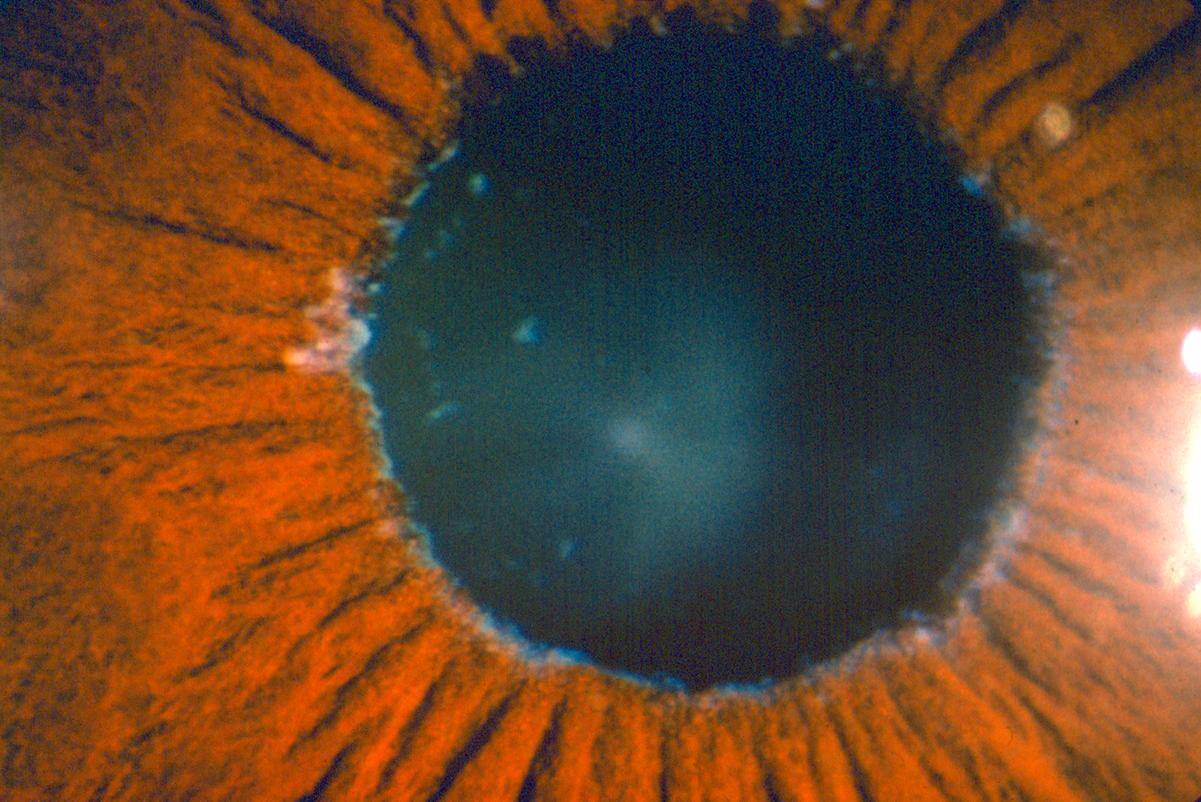 What Are the Types of Glaucoma? | Michigan Glaucoma & Cataract