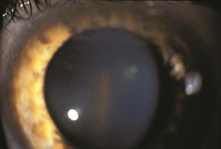 What Are the Types of Glaucoma? | Michigan Glaucoma & Cataract