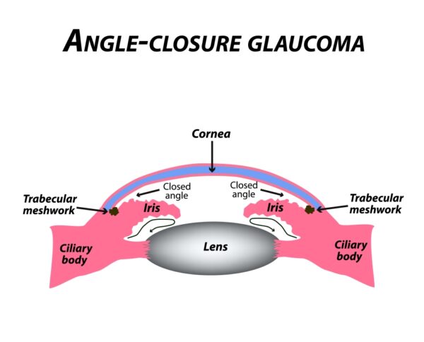 What Are the Types of Glaucoma? | Michigan Glaucoma & Cataract