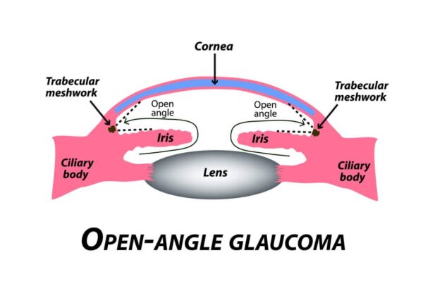 What Are the Types of Glaucoma? | Michigan Glaucoma & Cataract