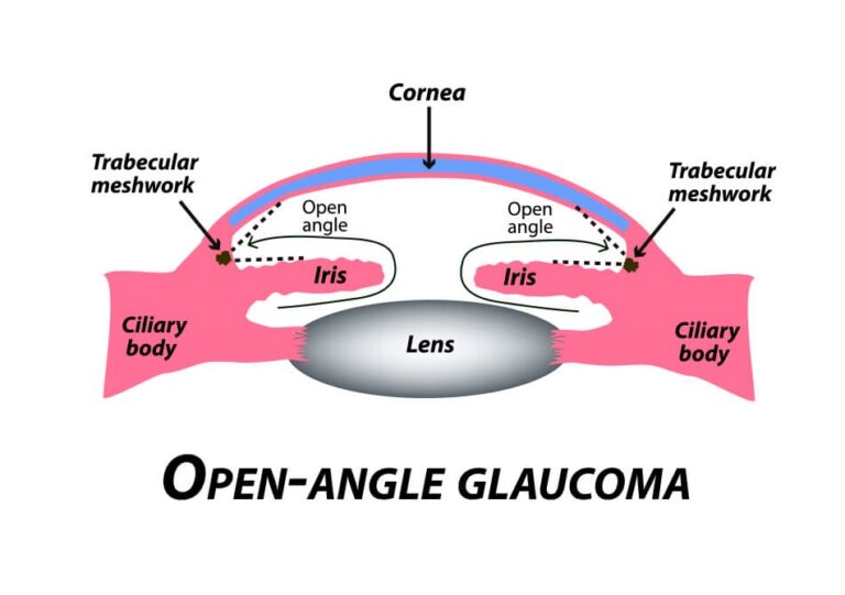 What Are the Types of Glaucoma? | Michigan Glaucoma & Cataract