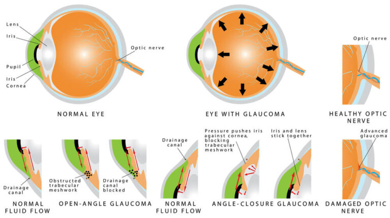 What Are the Types of Glaucoma? | Michigan Glaucoma & Cataract