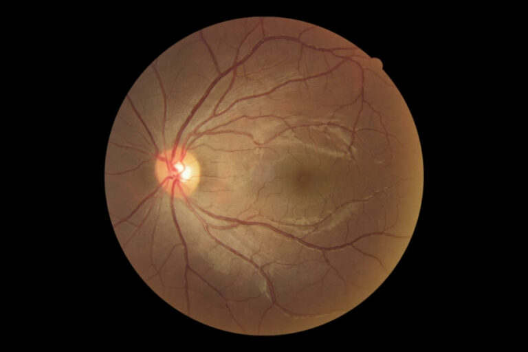 What Are the Types of Glaucoma? | Michigan Glaucoma & Cataract